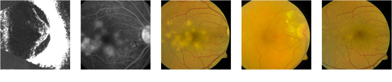 IOIS International Ocular Inflammation Society